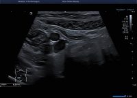Normal colon – Atlas of Ultrasound
